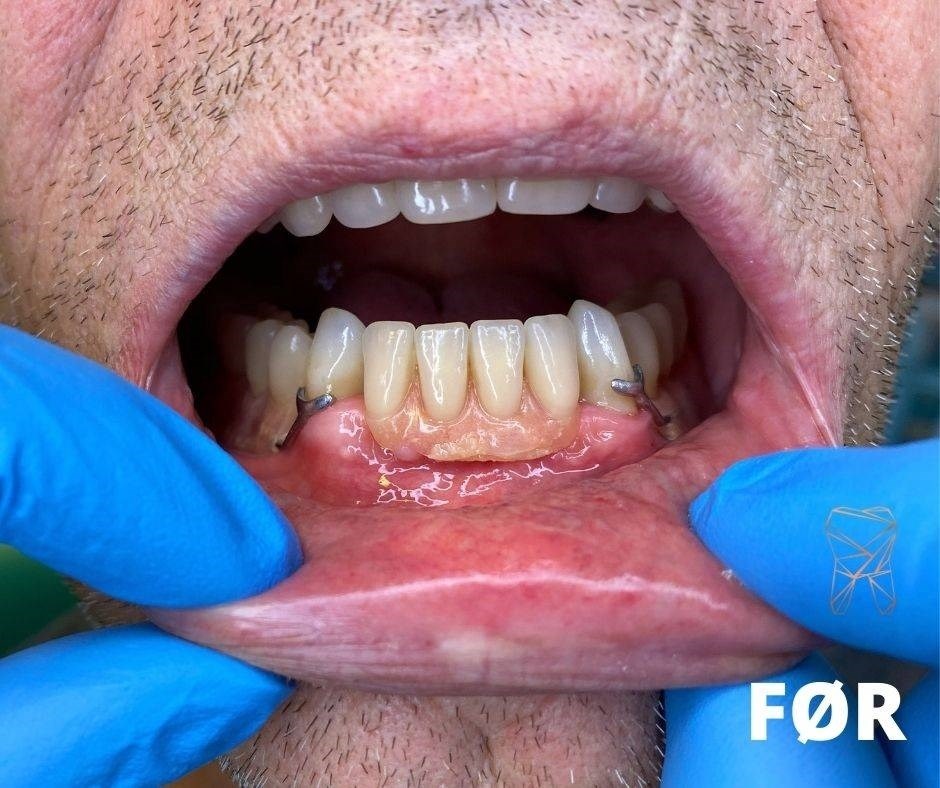Tandprotese FØR og EFTER Galleri - Se Billeder af Resultaterne