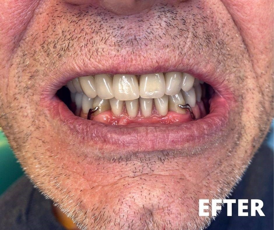 Tandprotese FØR og EFTER Galleri - Se Billeder af Resultaterne