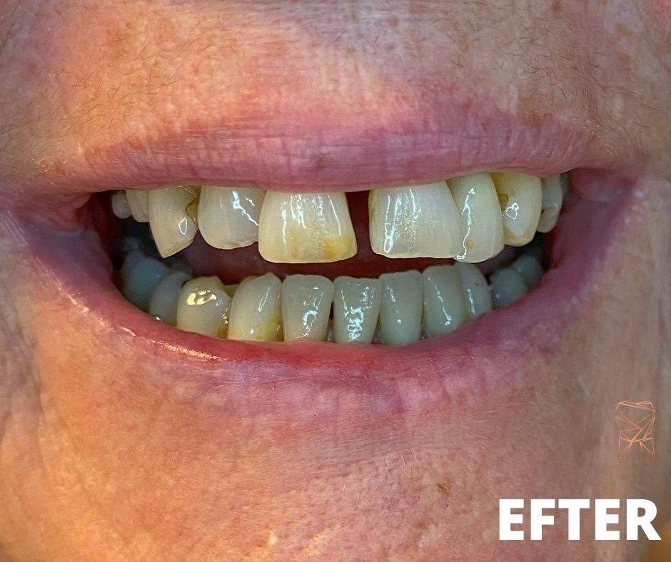 Tandprotese FØR og EFTER Galleri - Se Billeder af Resultaterne