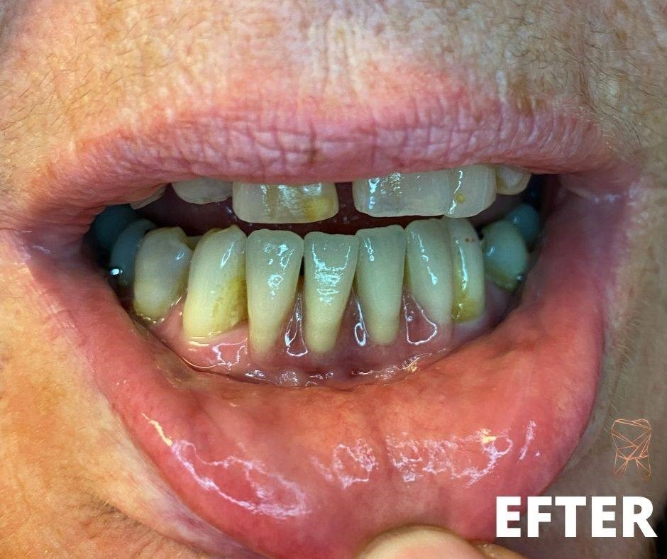 Tandprotese FØR og EFTER Galleri - Se Billeder af Resultaterne